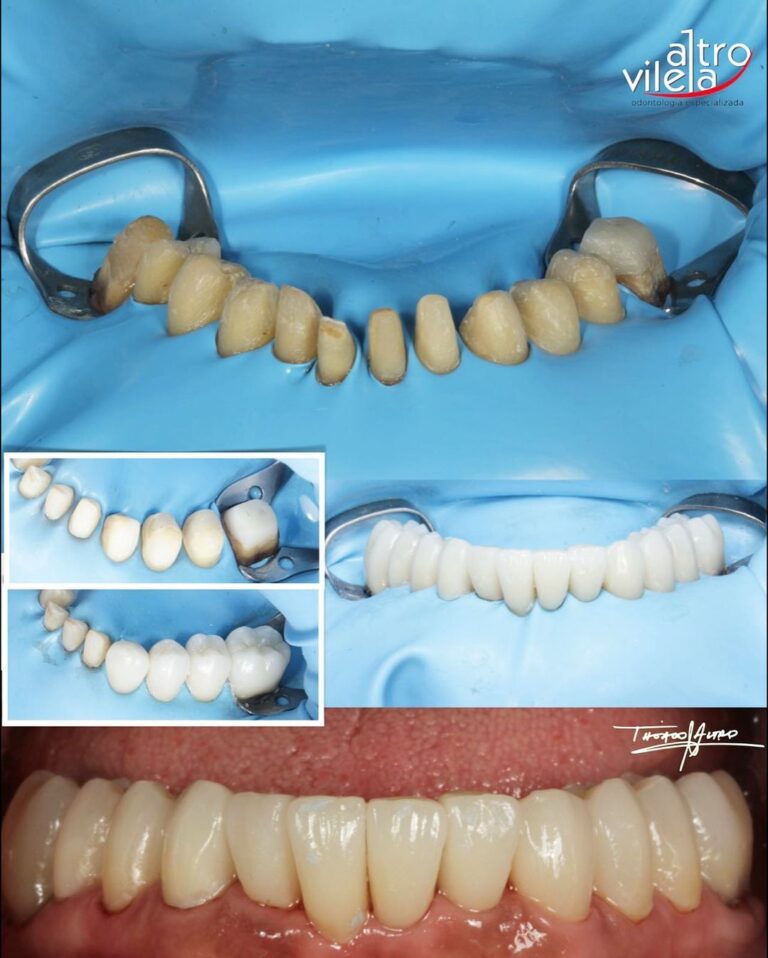 Isolamento Absoluto: eficiência em tratamentos odontológicos - GM7 Club ...